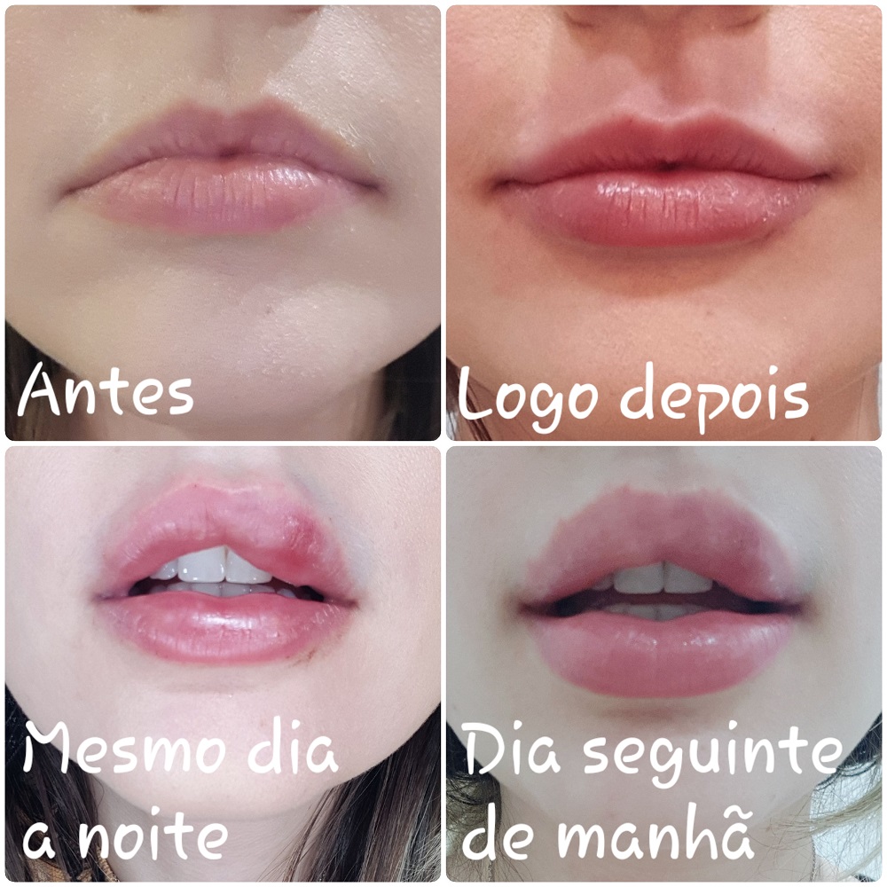 Preenchimento Labial • Thaís Patti